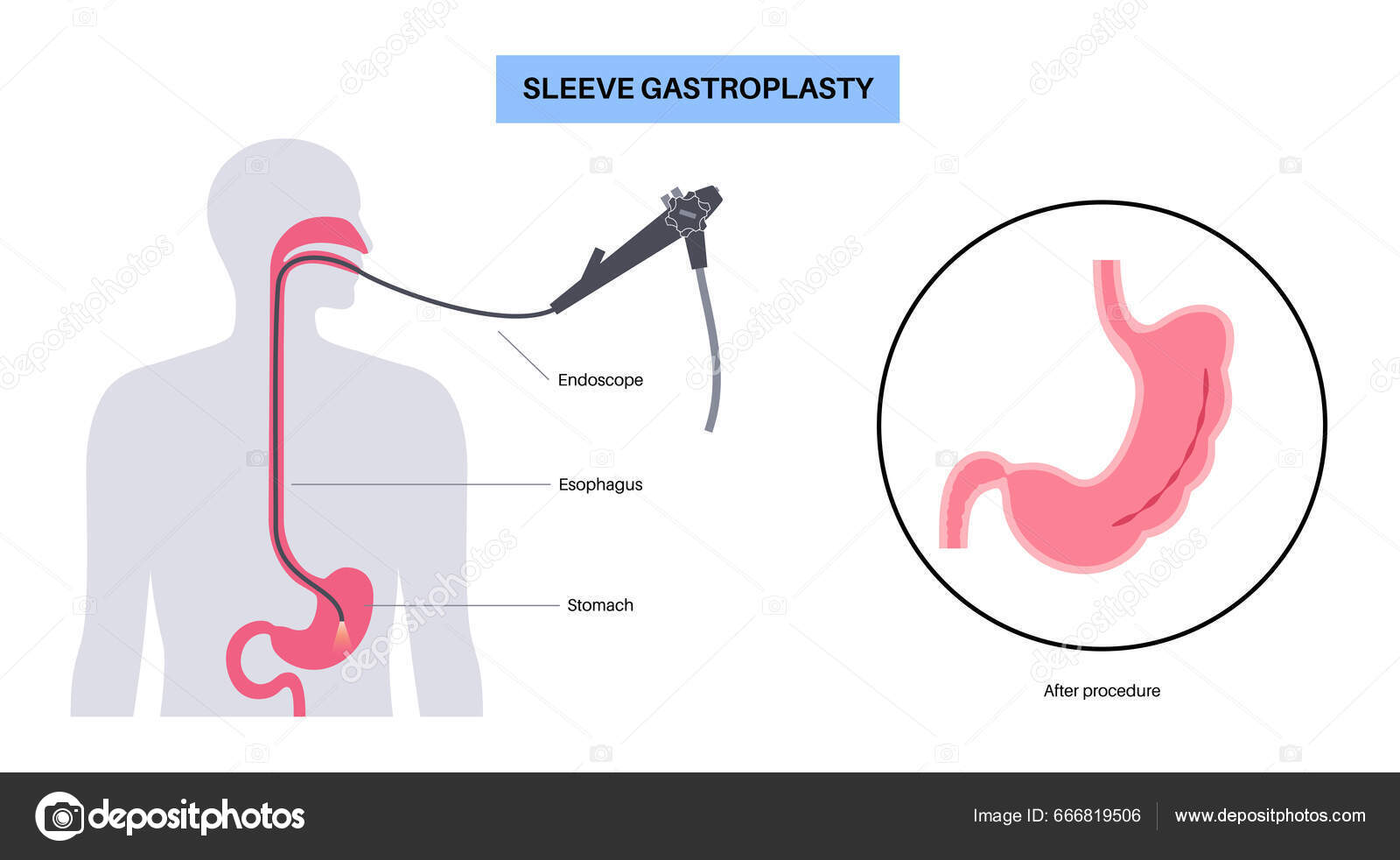 Endoscopic Sleeve Gastroplasty Stomach Surgery Weight Loss Gastric ...