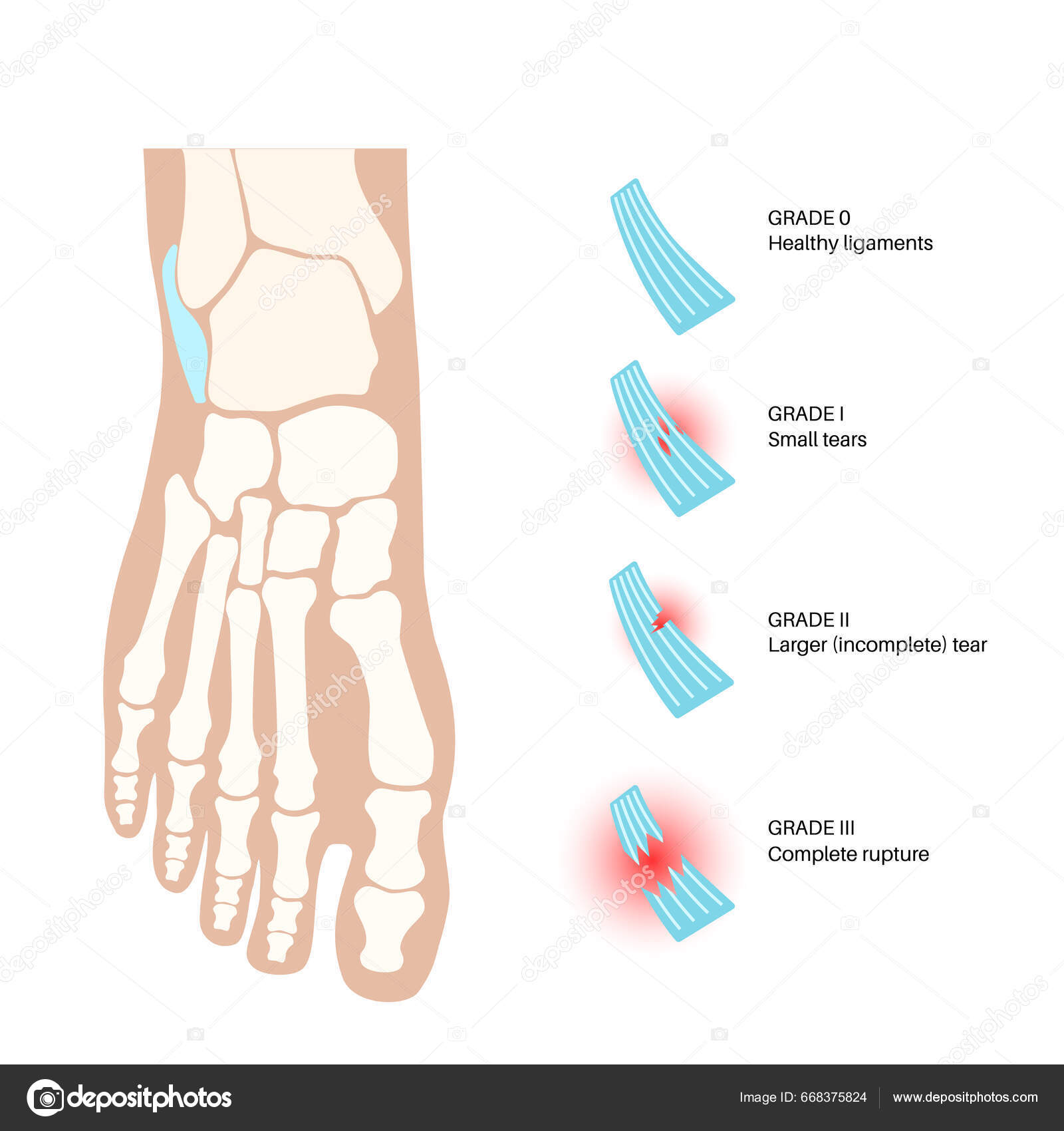 Esguince Tobillo Pies Torcidos Dolor Hinchazón Lágrimas Estiramiento ...