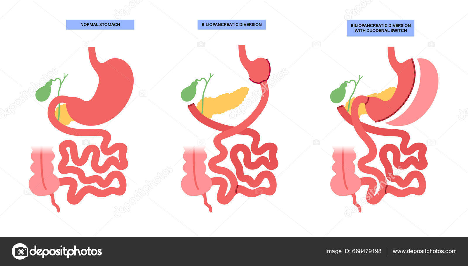 Biliopancreatic Diversion Duodenal Switch Bpd Stomach Surgery Weight ...