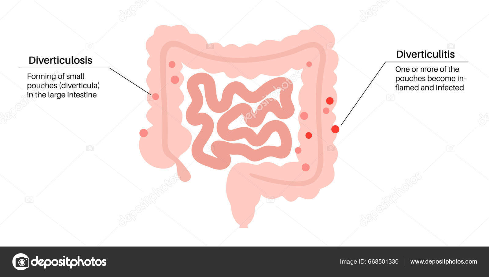 Diverticulite Doenças Diverticulose Divertículos Nas Paredes Intestino ...