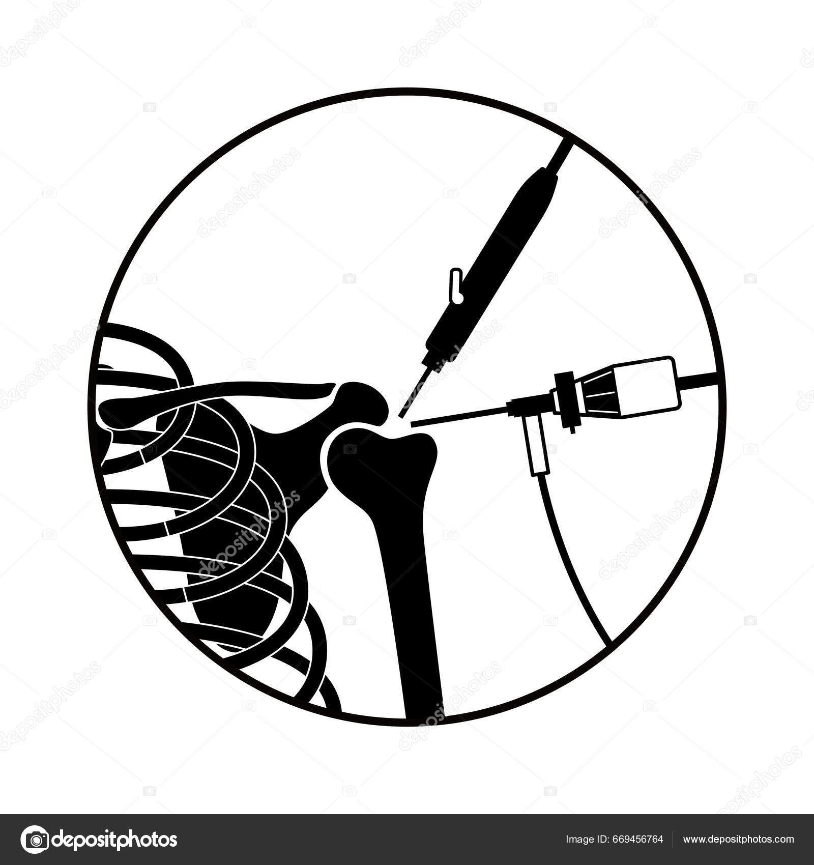 Procedimiento Artroscopia Hombro Desgarros Del Manguito Rotador ...