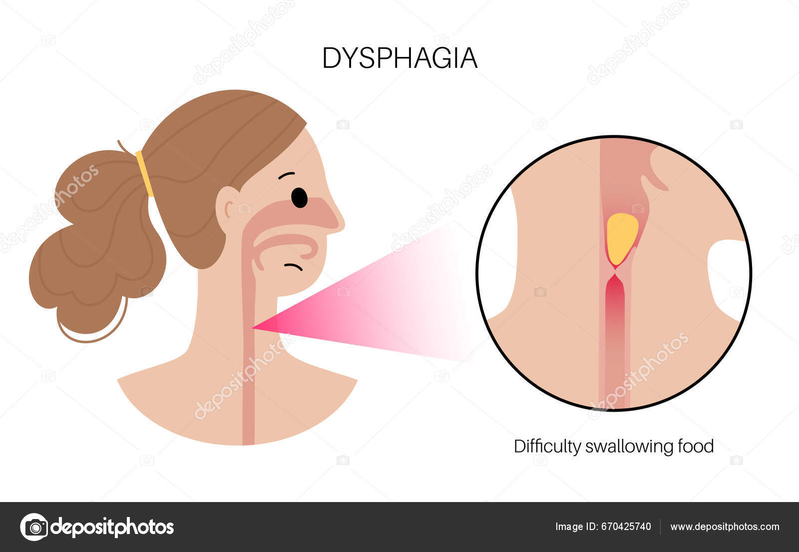 Dysphagia Medical Poster Difficult Painful Swallowing Esophagus Disease ...