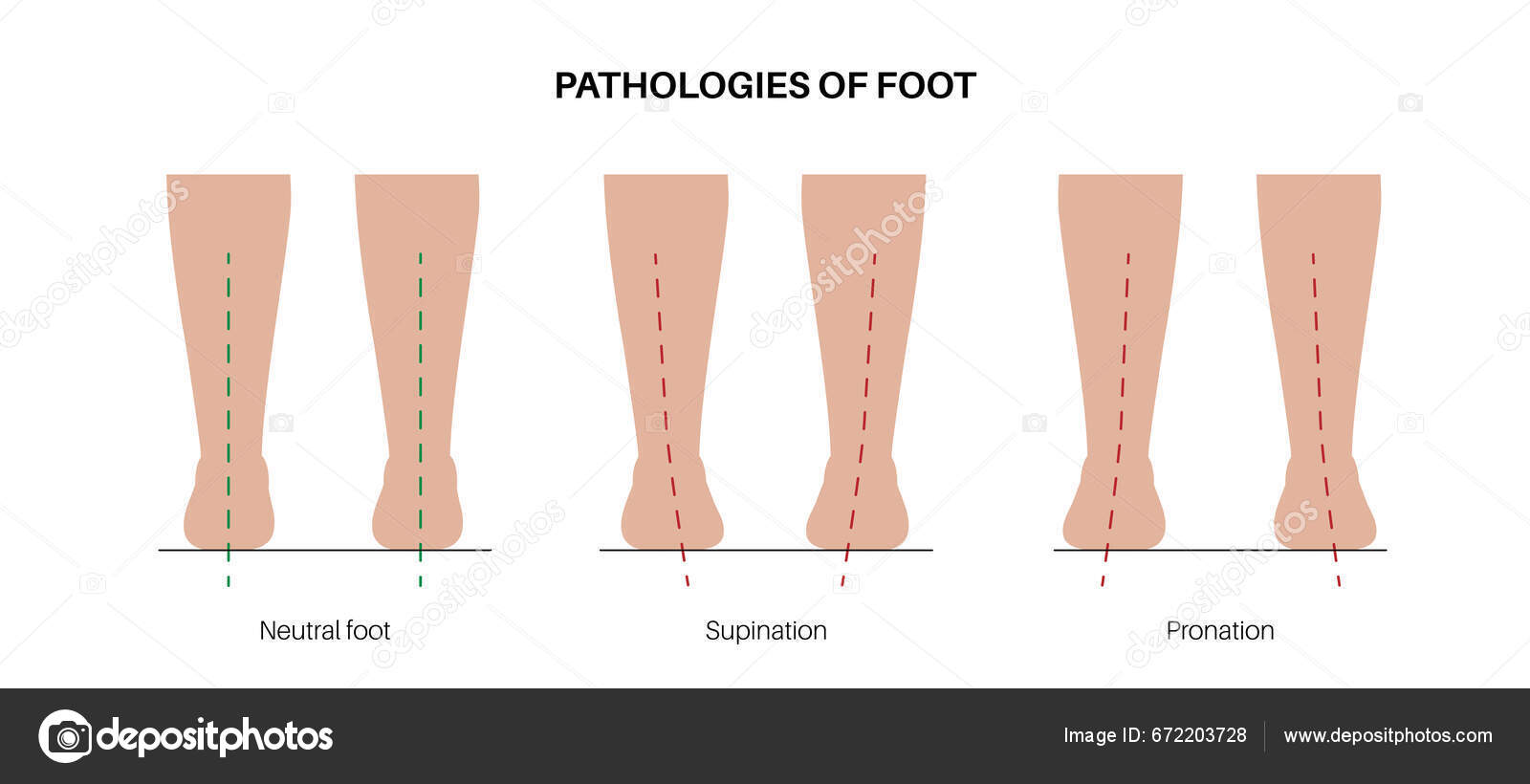 Pronación Sobrepronación Posición Del Pie Supinación Patologías Los ...