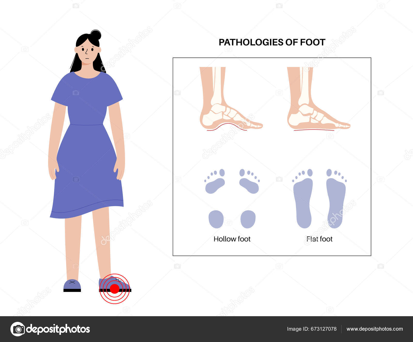 Supination Footprint