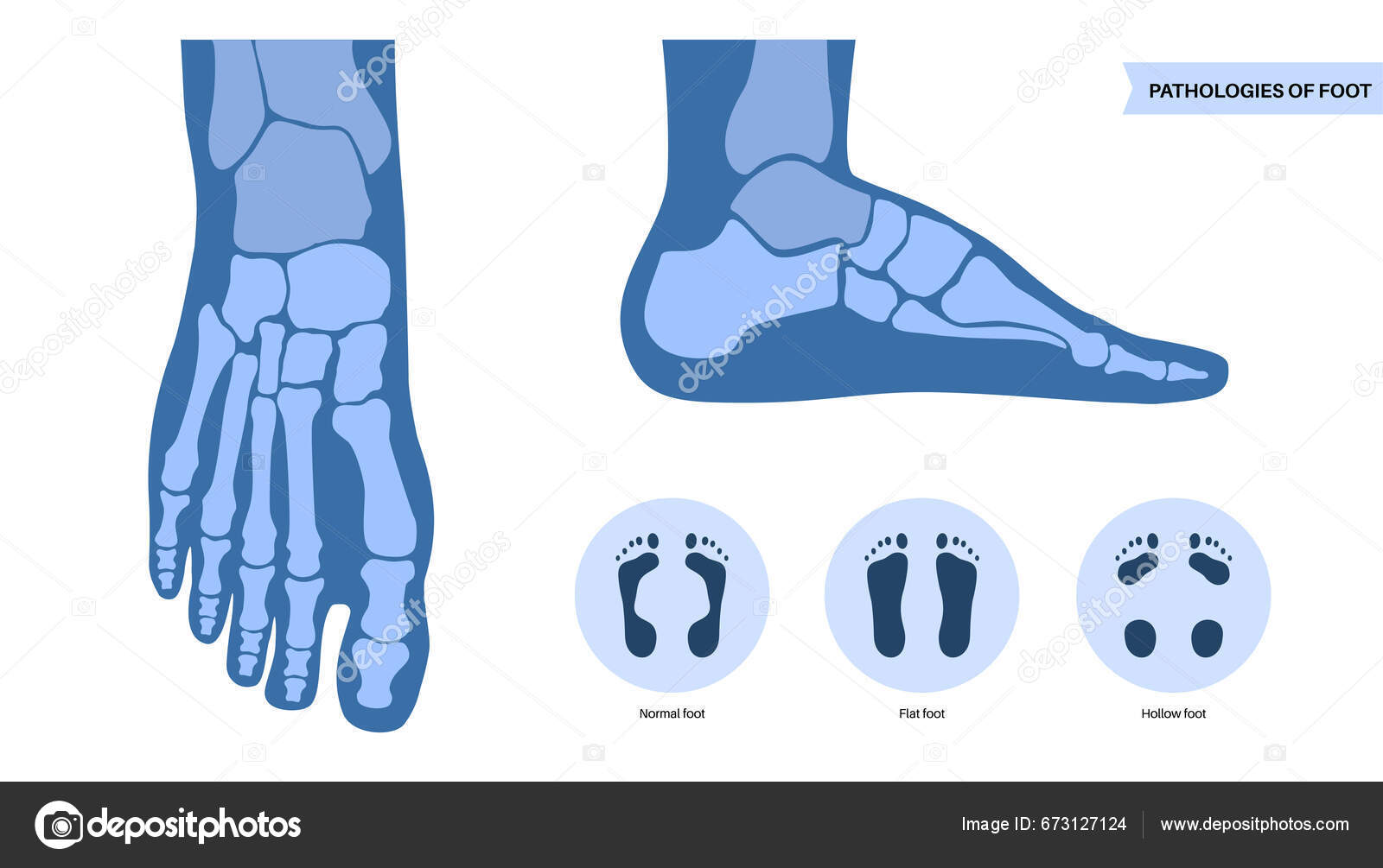 Patologías Del Pie Póster Anatómico Condiciones Pies Planos Normales ...
