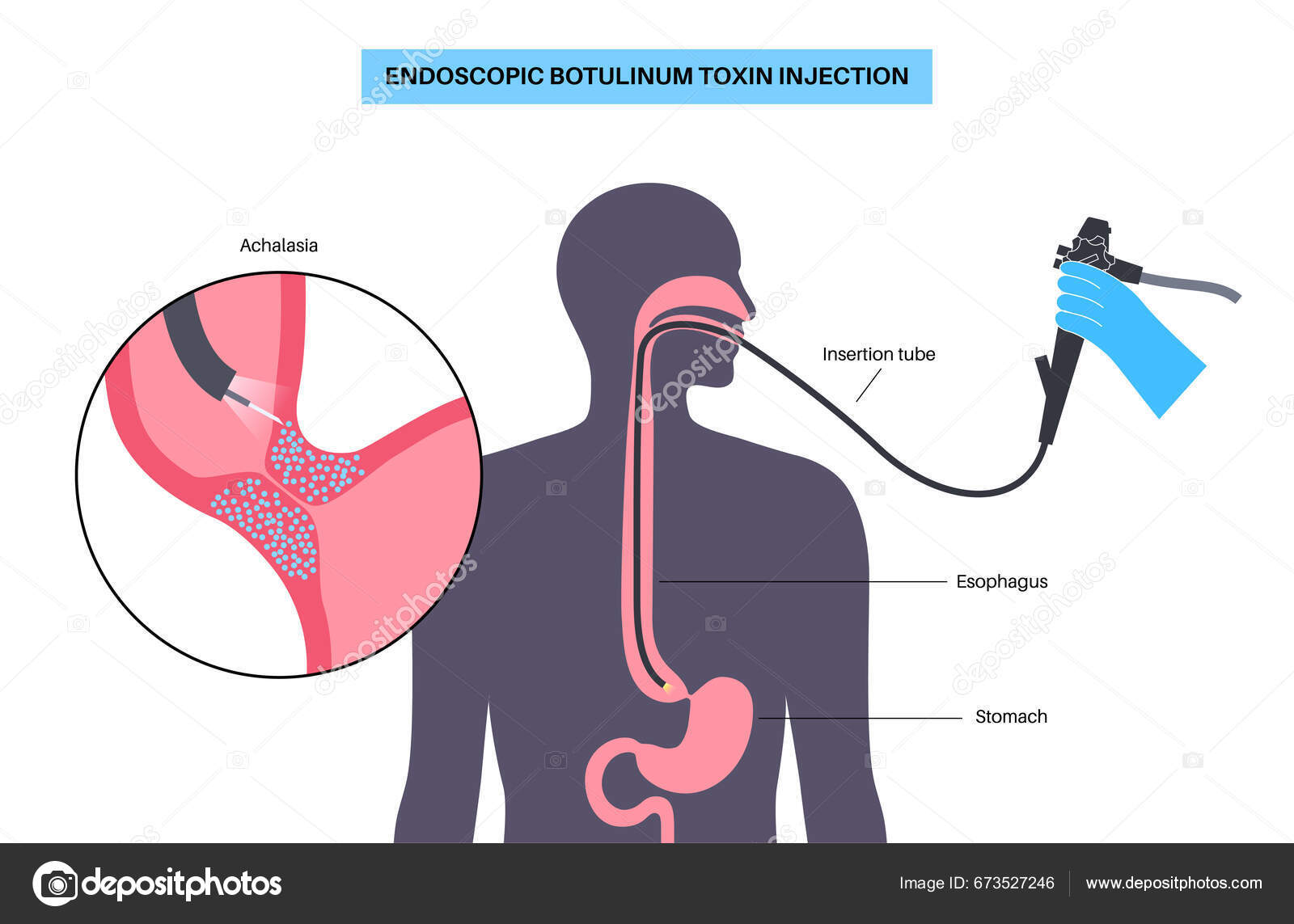 Esophageal Achalasia Disease Botulinum Toxin Injection Treatment ...