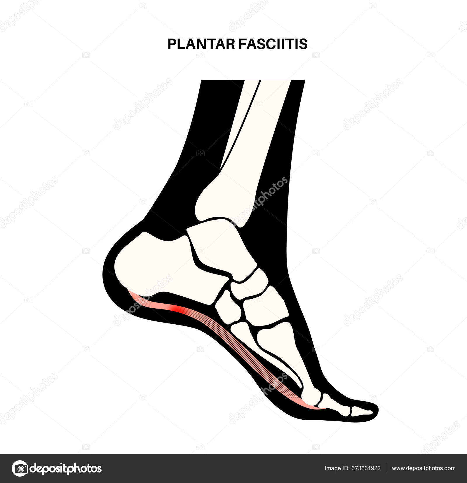Plantar Fasciit Anatomisk Affisch Sträckor Eller Tårar Plantar Fascia ...