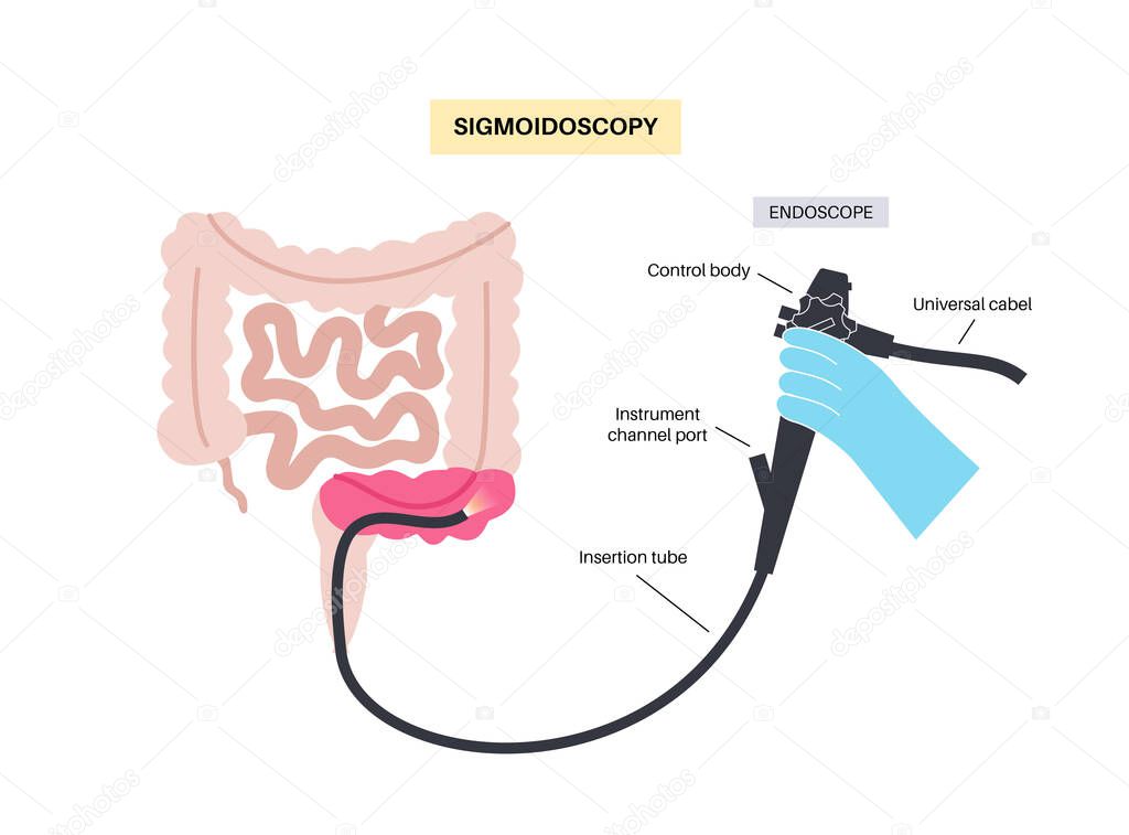 Prueba Colonoscopia Sigmoidoscopia Examen Tratamiento Del Intestino ...
