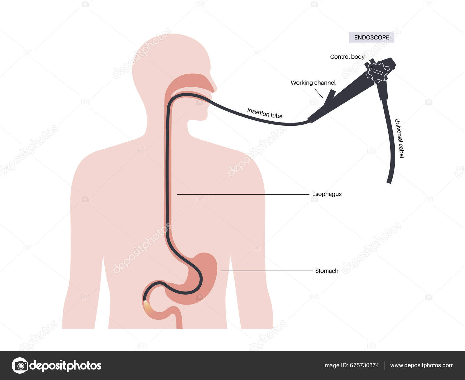 Afiche Médico Esofagogastroduodenoscopia Procedimiento Diagnóstico ...