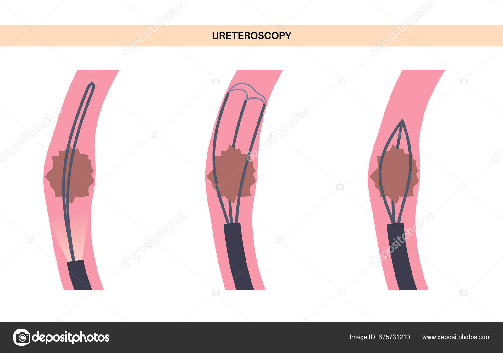 Ureteroscopy Procedure