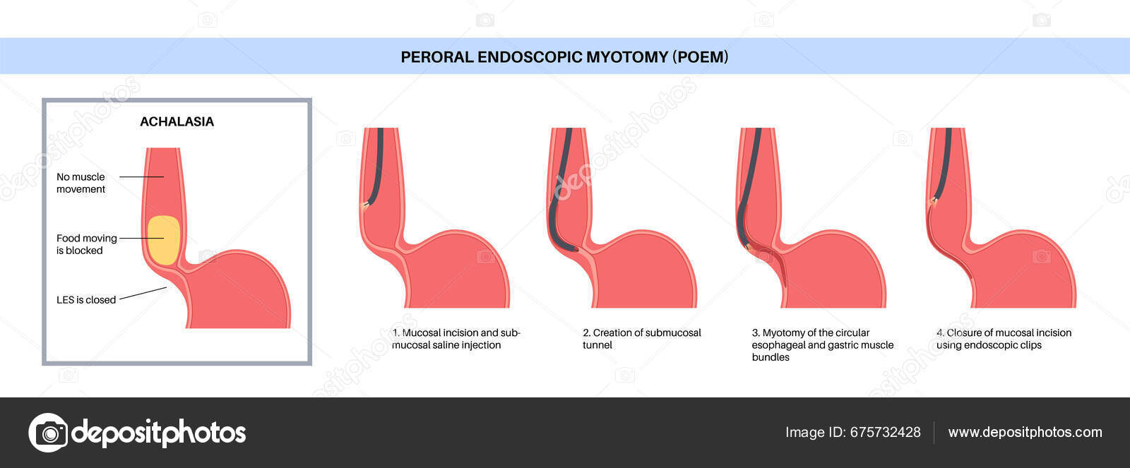 Peroral Endoscopic Myotomy Poem Minimally Invasive Procedure Disorder ...