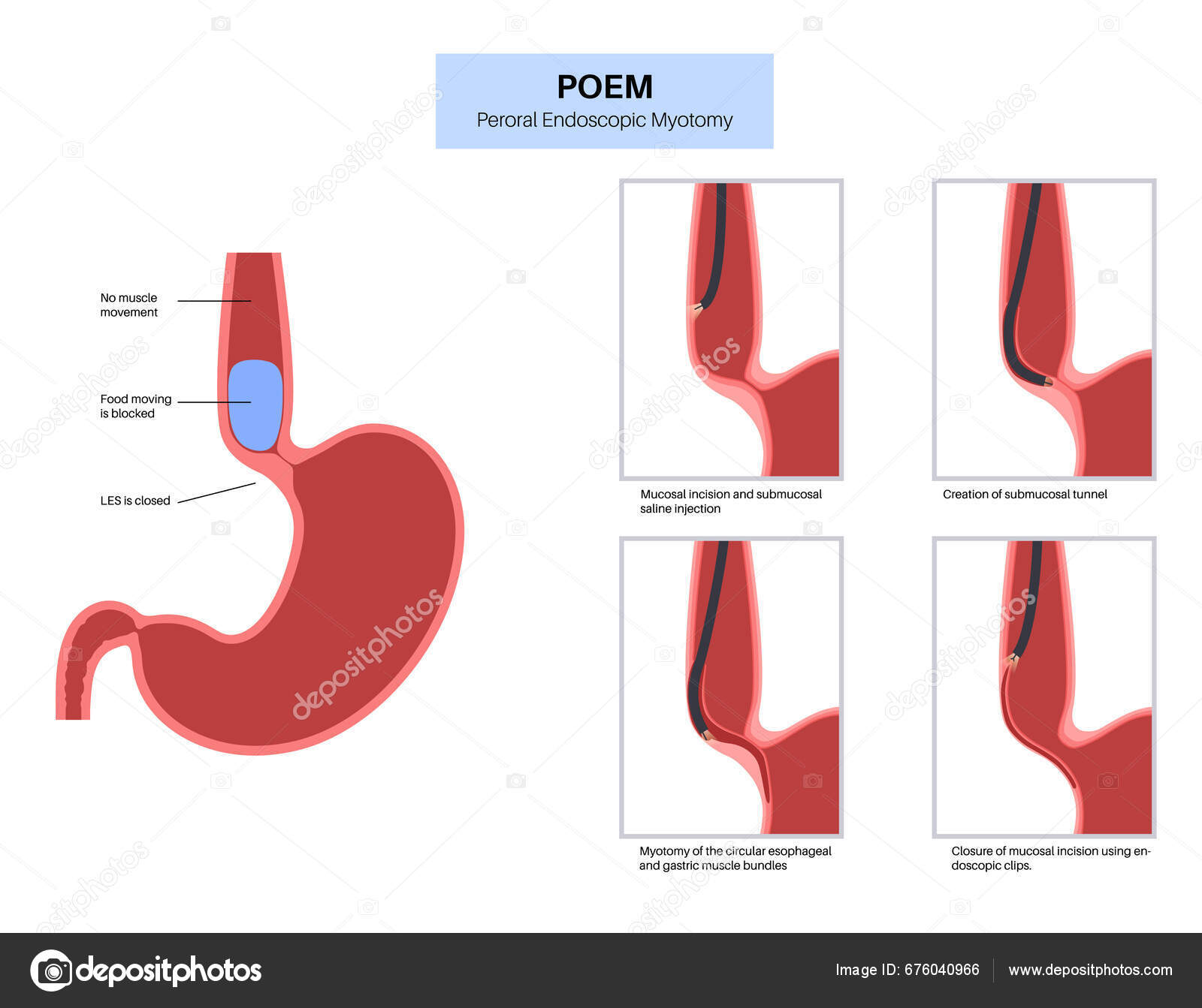 Perorale Endoskopische Myotomie Poem Minimalinvasives Verfahren Störung Der Speiseröhre ...