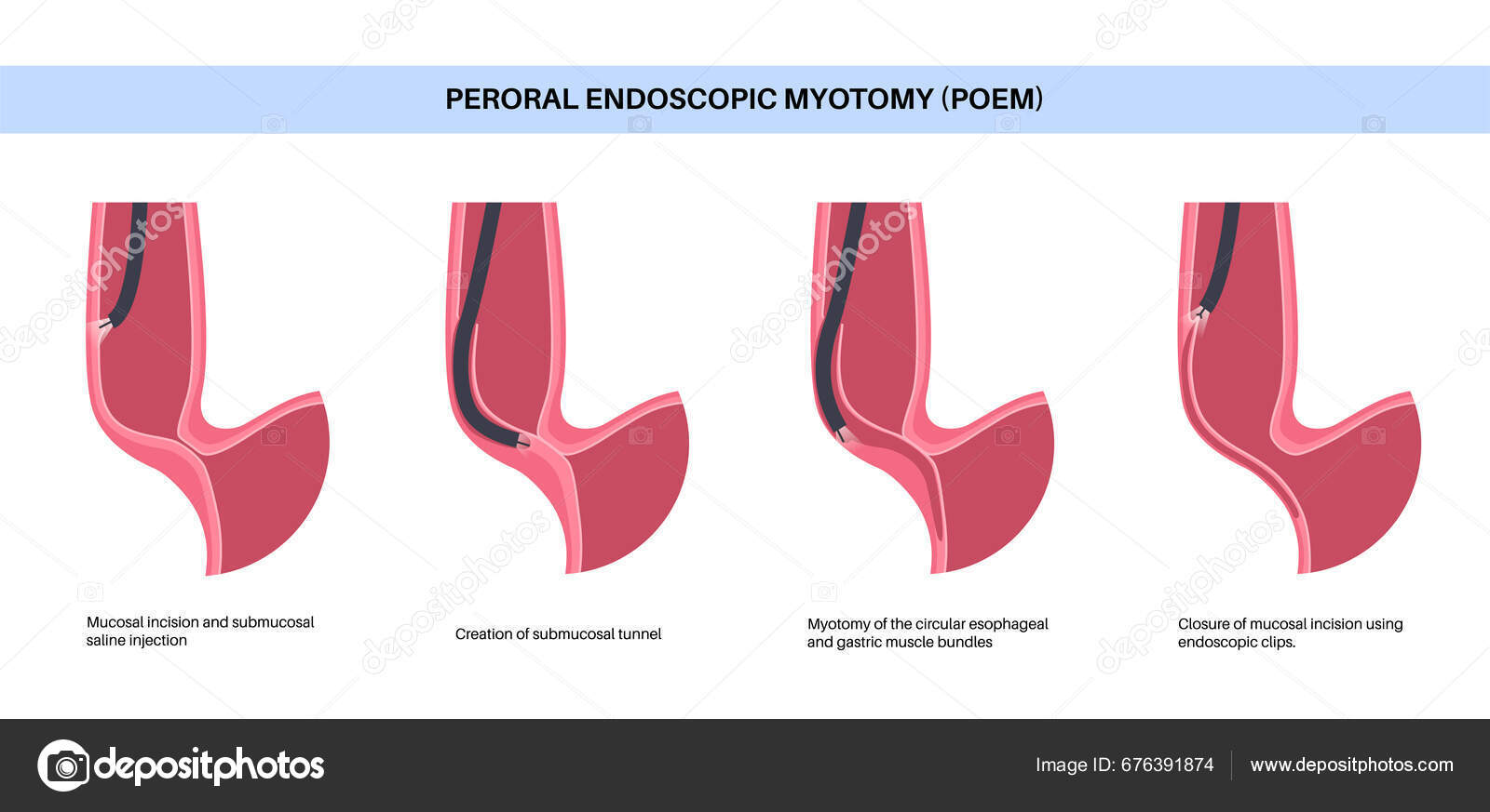 Perorale Endoskopische Myotomie Poem Minimalinvasives Verfahren Störung Der Speiseröhre ...
