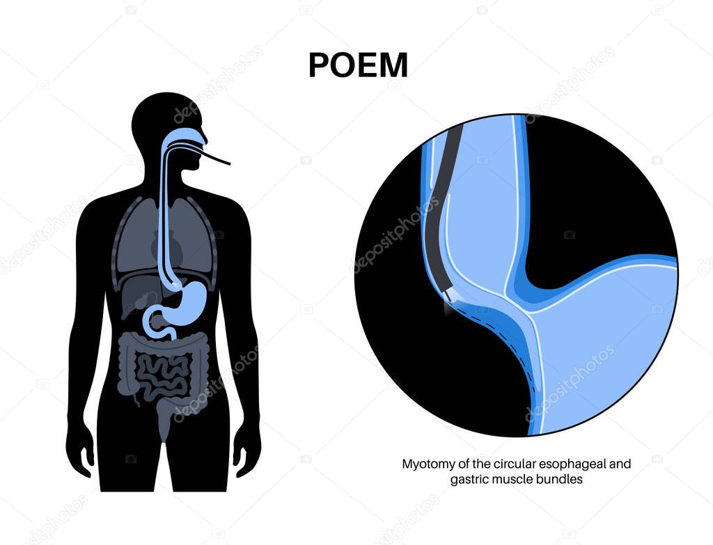 Miotomía endoscópica peroral. Procedimiento mínimamente invasivo del ...