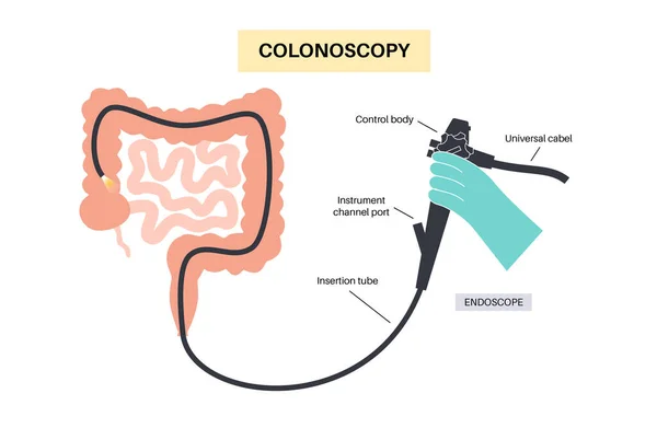 La colonoscopia es un procedimiento mínimamente invasivo. Examen y ...