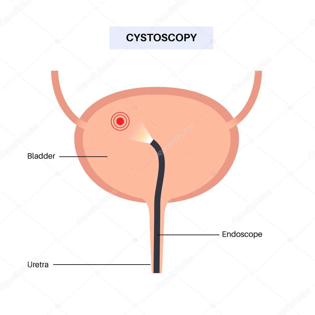 La cistoscopia es un procedimiento mínimamente invasivo. Examen y ...