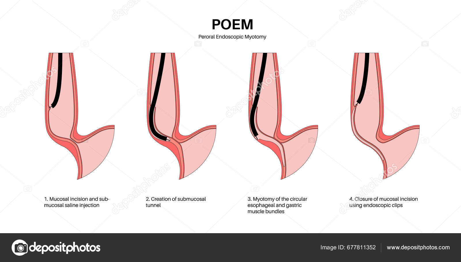 Perorale Endoscopische Myotomie Poem Minimaal Invasieve Procedure ...