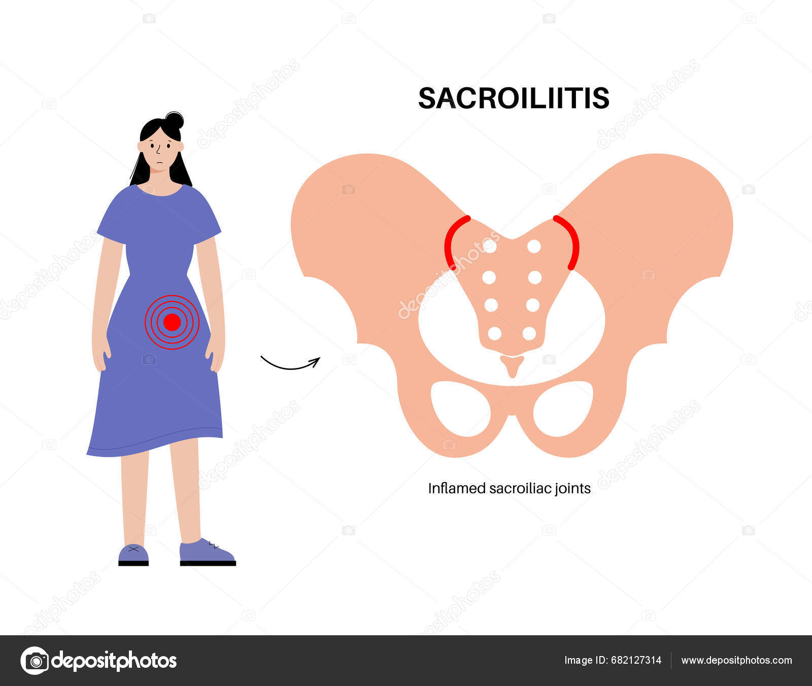 Sacroiliitis Disease Concept Inflamed Sacroiliac Joints Lower Spine ...