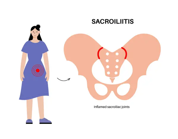 Sacroiliitis Disease Concept Inflamed Sacroiliac Joints Lower Spine ...