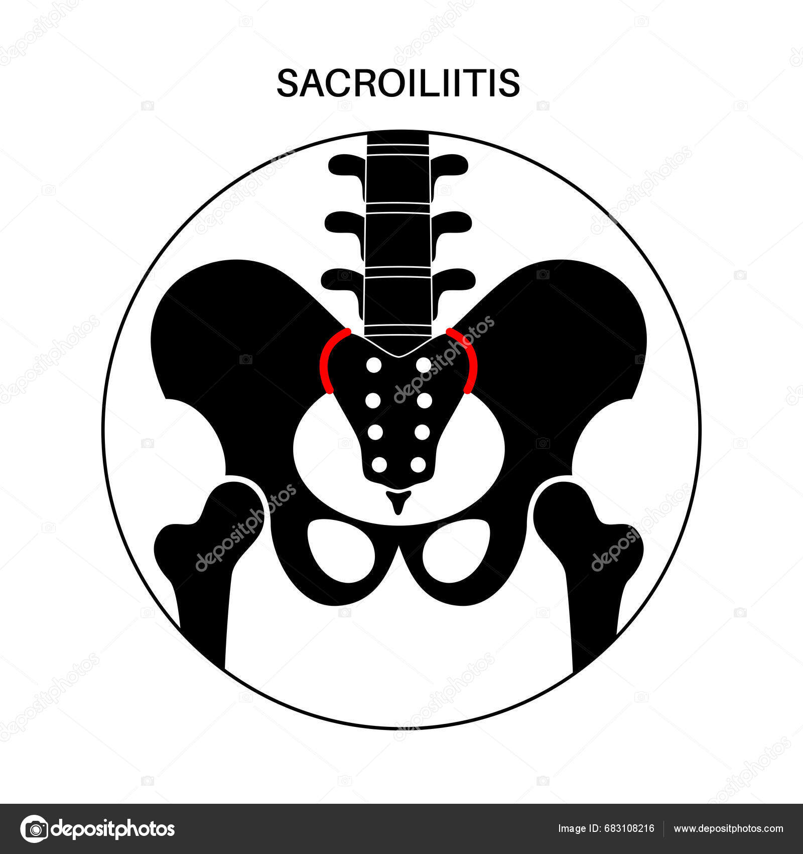 Sacroiliitis Disease Concept Inflamed Sacroiliac Joints Lower Spine ...
