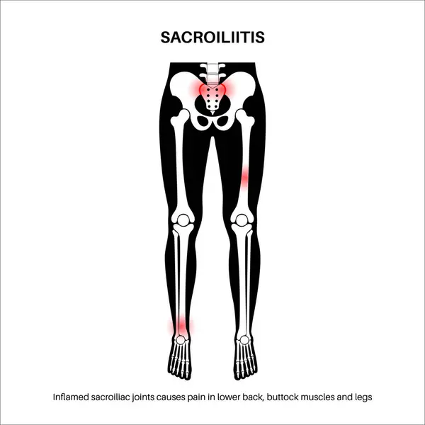 Sacroiliitis Disease Concept Inflamed Sacroiliac Joints Lower Spine ...