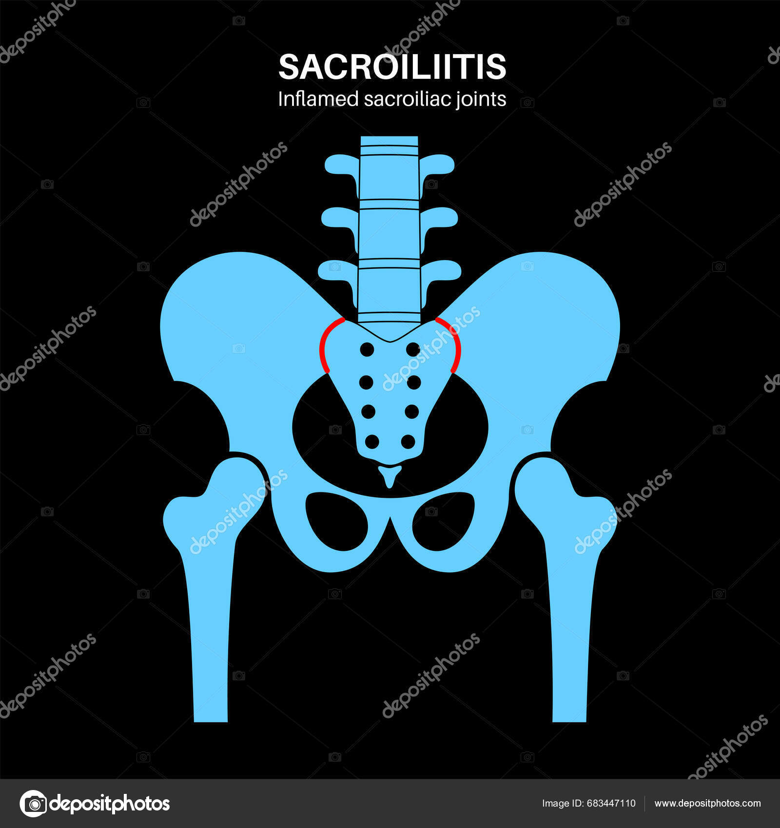 Sacroiliitis Disease Concept Inflamed Sacroiliac Joints Lower Spine ...