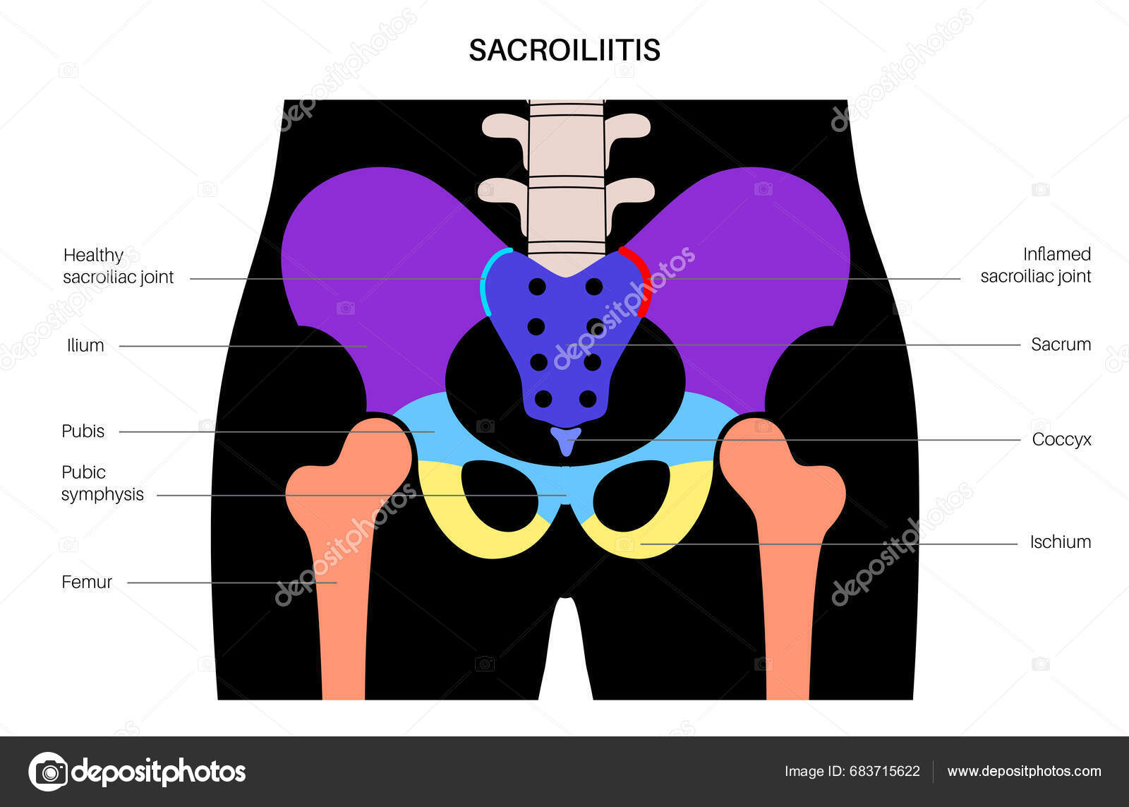 Konsep Penyakit Sacroiliitis Radang Sendi Sakroiliak Tulang Belakang ...