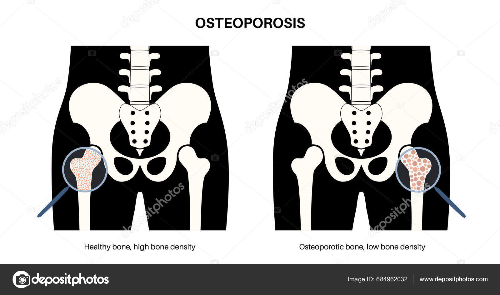 Cartel Enfermedad Osteoporosis Trastorno Esquelético Sistémico Pérdida ...