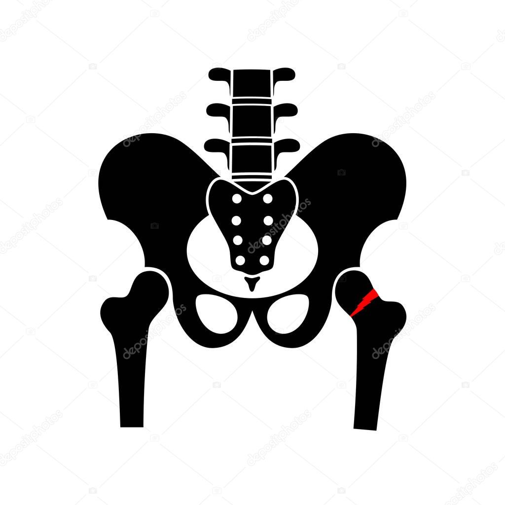 Cartel de fractura de hueso de cadera. Concepto de lesión en la pierna ...