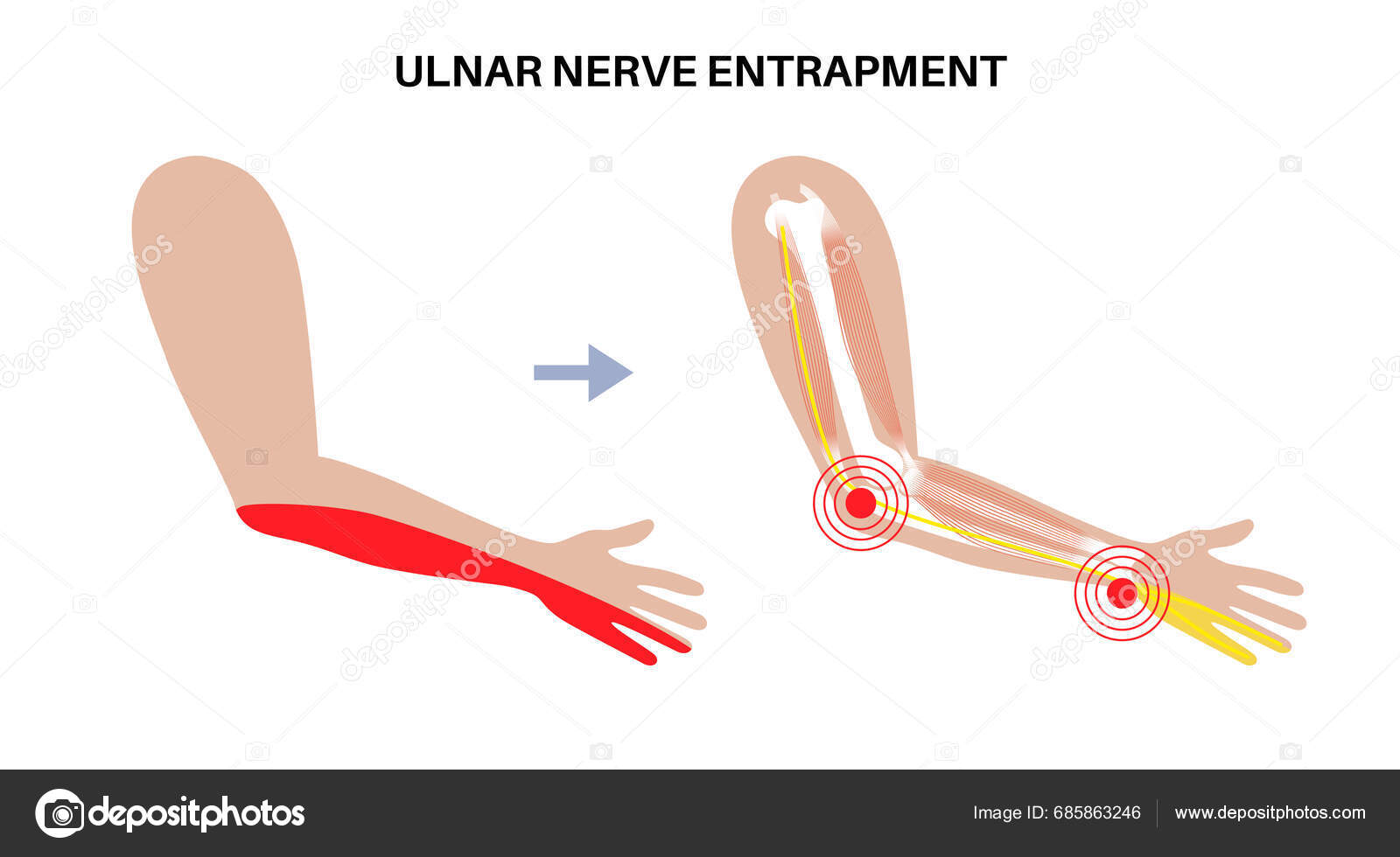 Ulnar Nerve Entrapment Cubital Tunnel Syndrome Guyons Canal Syndrome ...