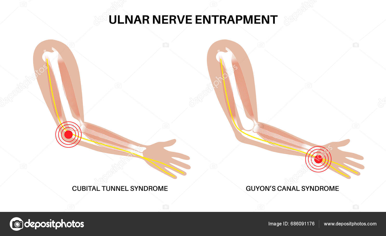 Image vectorielle Piégeage Des Nerfs Ulnaires Syndrome Tunnel Cubital ...