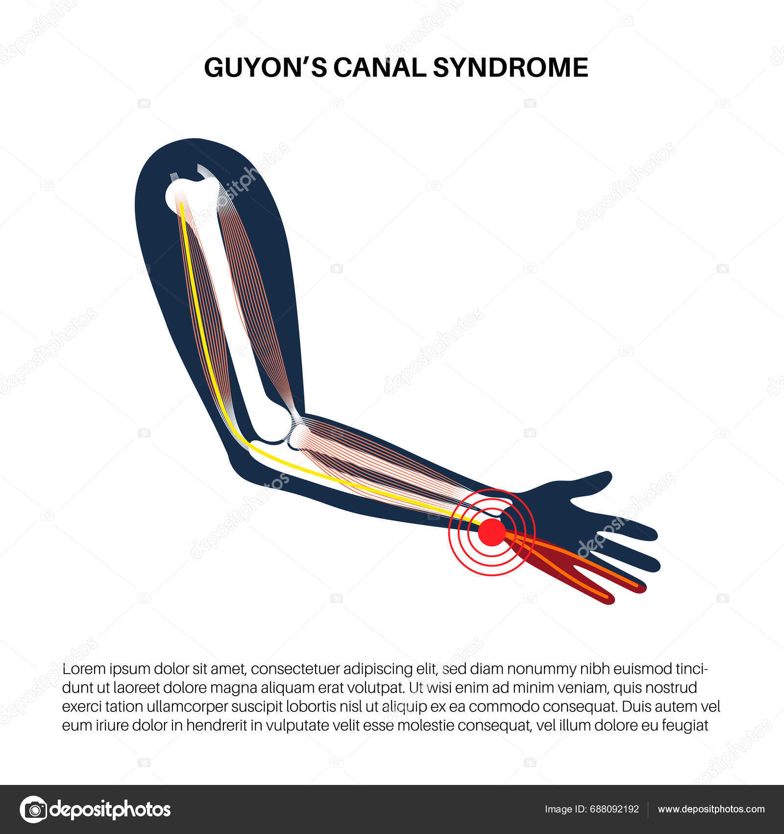 Guyons Canal Syndrome Pressure Pulling Stretching Ulnar Nerve Wrist Region Stock Vector By