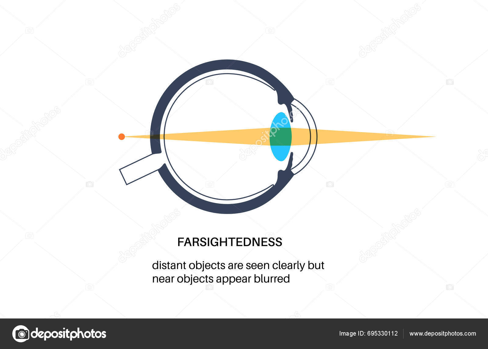 Farsightedness Eye Disease Poster Hyperopia Long Sightedness Refractive ...