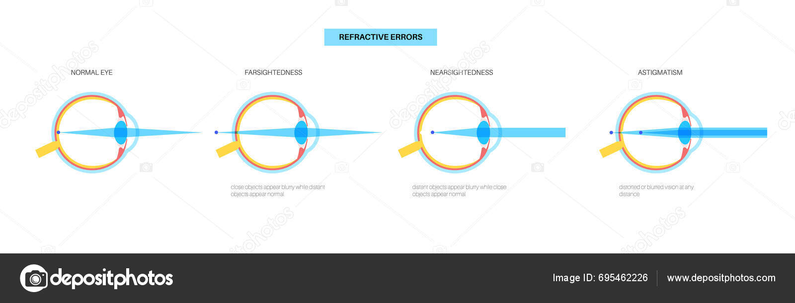 Refractive Errors Poster Normal Eye Astigmatism Myopia Hyperopia ...