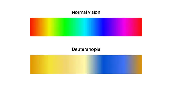 Deuteranopia Normal Vision Color Blindness Infographic Human Vision ...