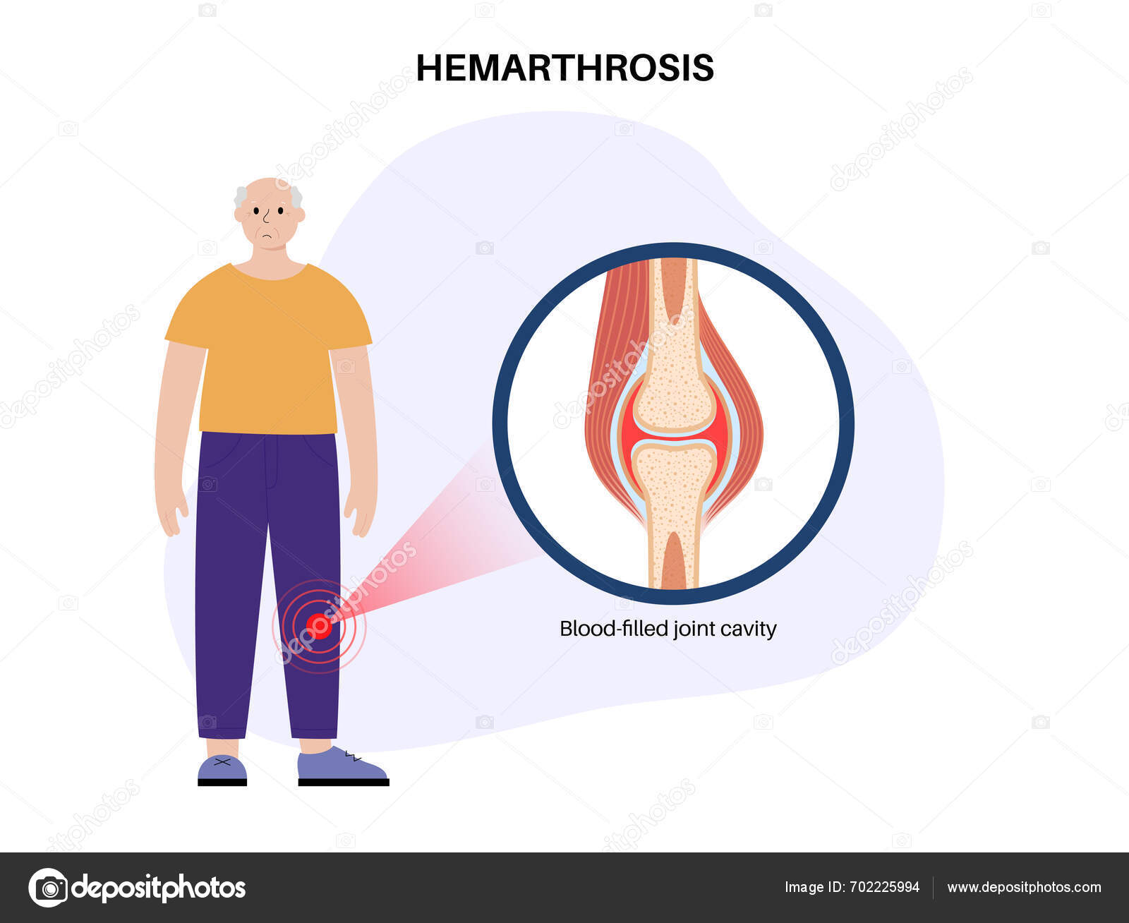 Hemarthrosis Disease Medical Poster Bleeding Synovial Joints Physical ...