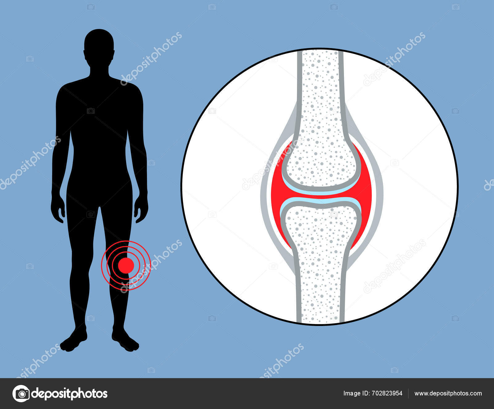 Hemarthrosis Disease Medical Poster Bleeding Synovial Joints Physical ...