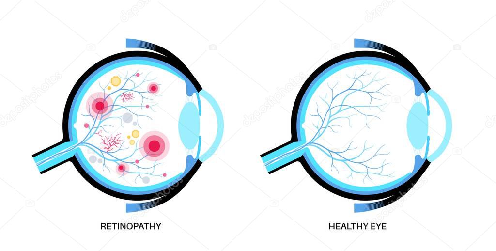 Anatomía de retinopatía diabética. Ojo sano y órgano dañado. Enfermedad ...
