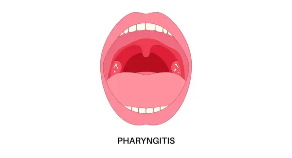 Pharyngitis Vector Images | Depositphotos