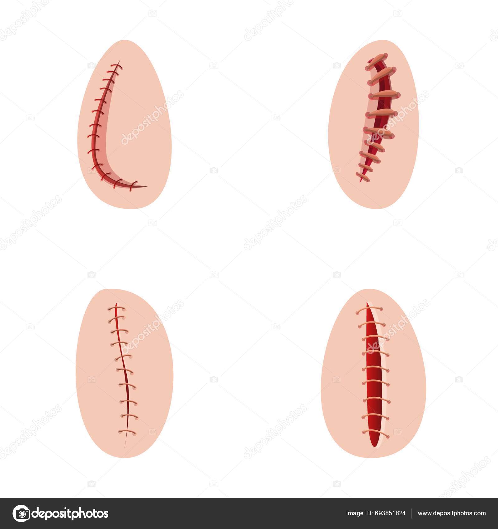 Operating Suture Icons Set Cartoon Vector Various Type Surgical Suture ... Operating Suture Icons Set Cartoon Vector Various Type Surgical Suture ...