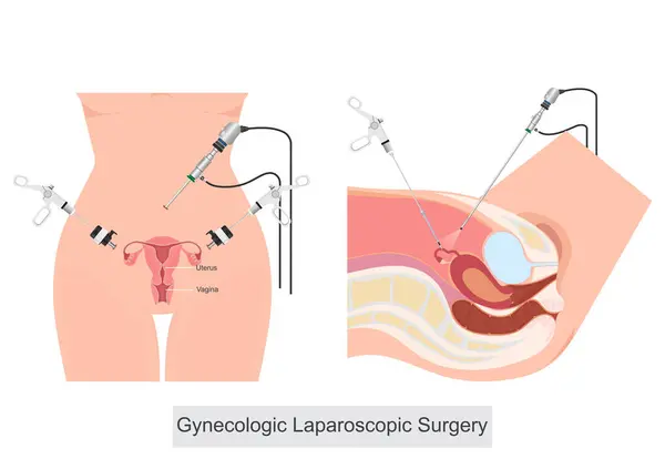 Laparoscopy Vector Images | DepositPhotos