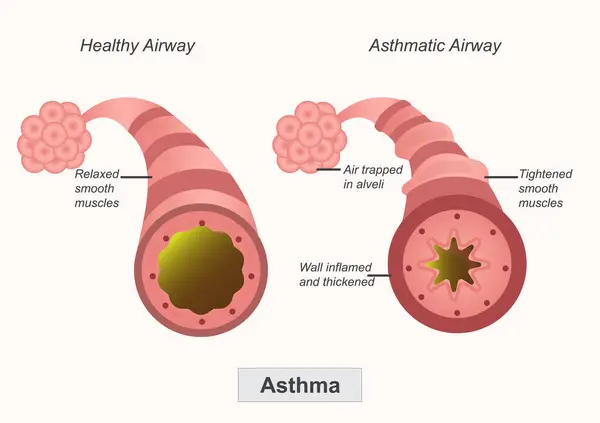 Vectores de Asma bronquial, imágenes vectoriales | Depositphotos