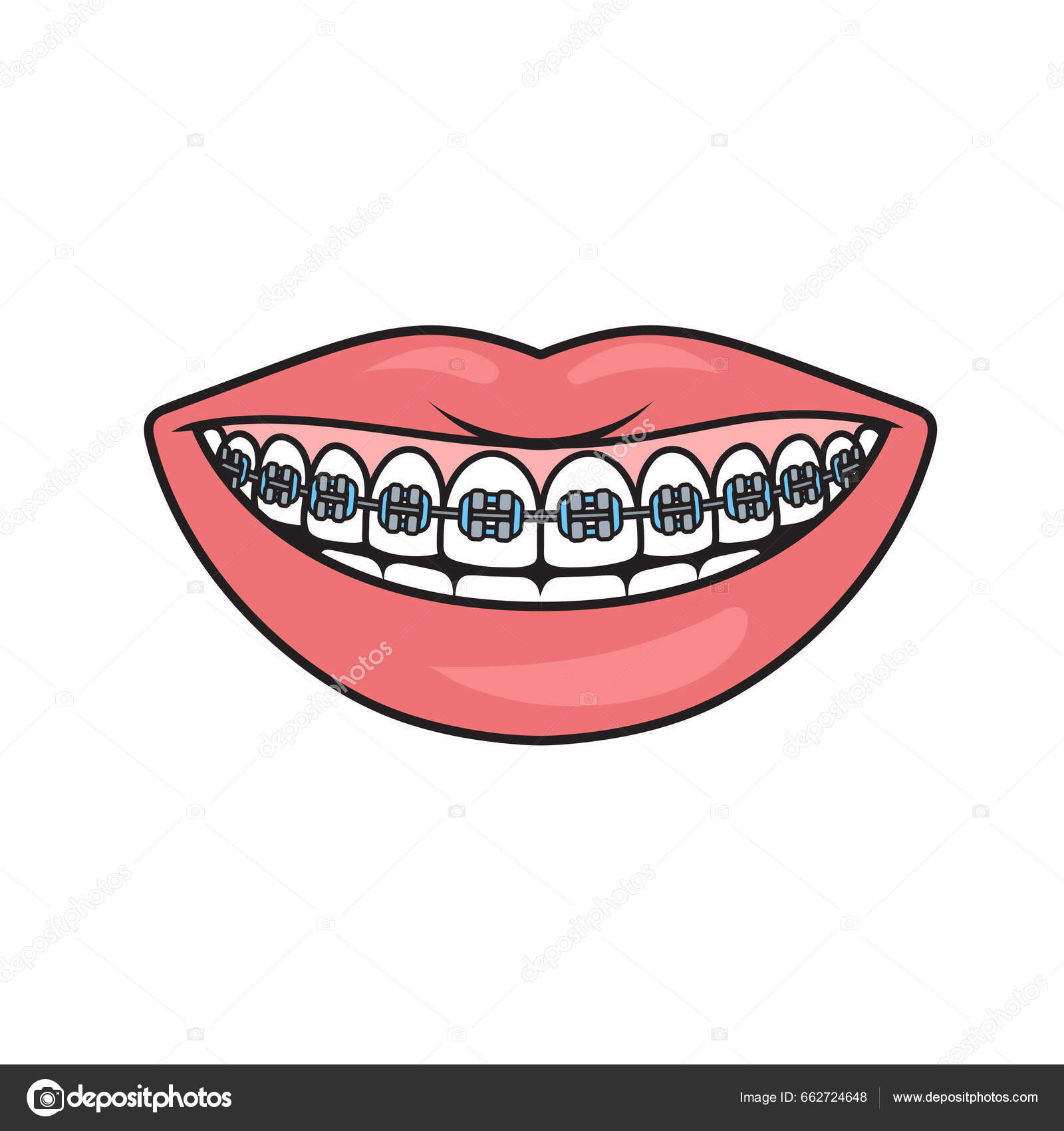 Dental Braces Teeth Smile Schematic Diagram Vector Illustration Medical ...