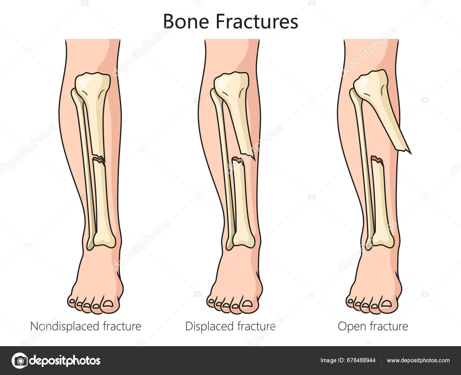 Types Bone Fractures Diagram Schematic Raster Illustration Medical ...
