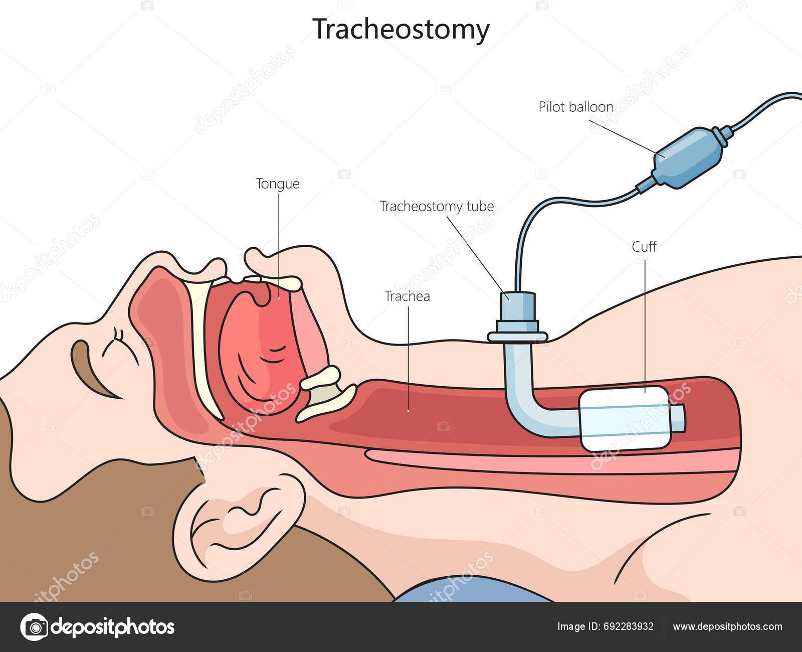 Tracheotomy Rør Struktur Rygsøjlen Diagram Håndtegnet Skematisk Raster ...