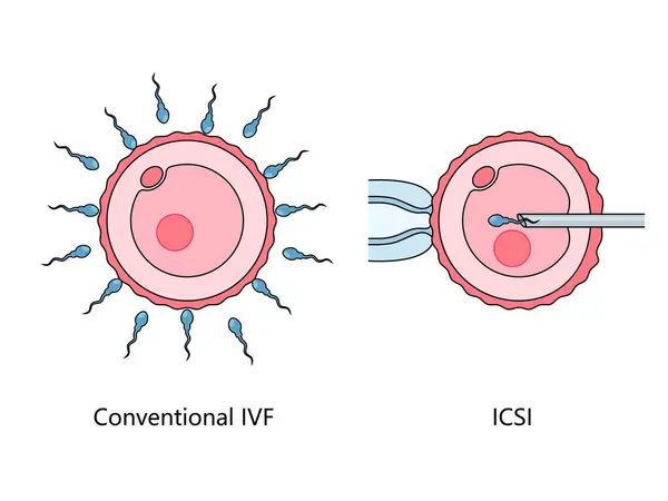 contraste convencional In Vitro Fertilización FIV con Inyección Intracitoplasmática de ...