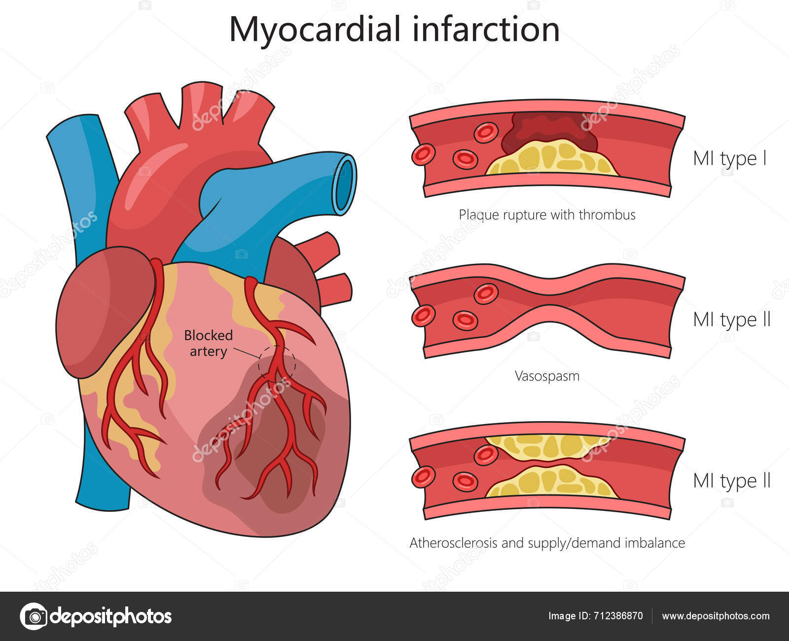 Emberi Szív Anatómia Különböző Típusú Miokardiális Infarktus Oktatási ...