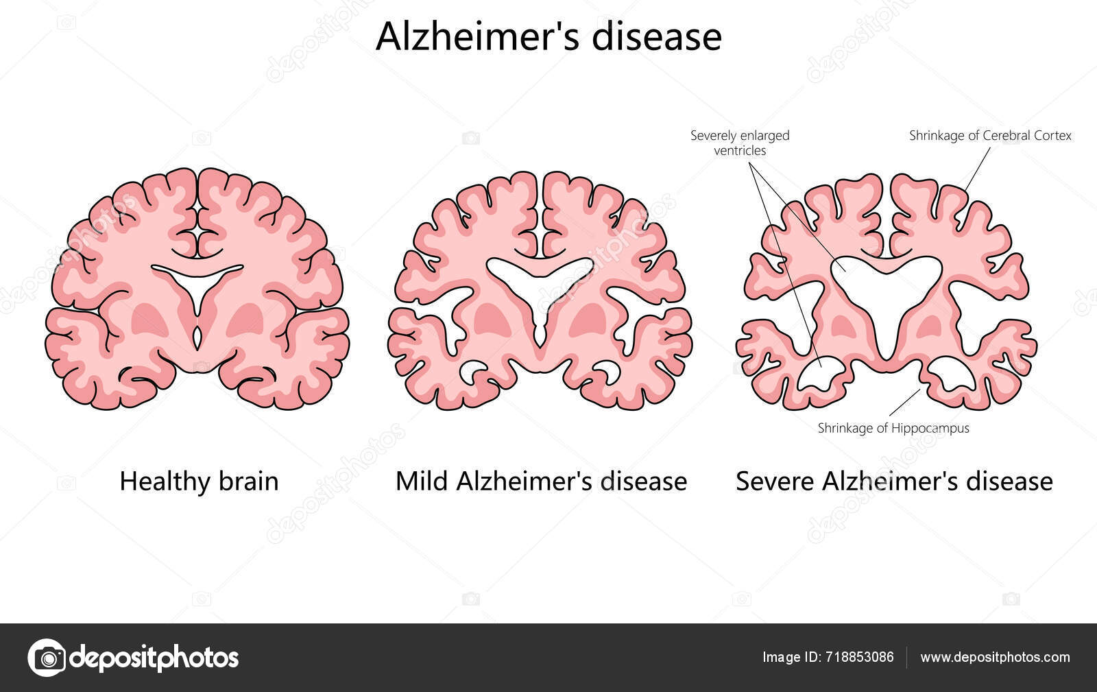 Progression Alzheimer Disease Comparing Healthy Brain Those Mild Severe ...