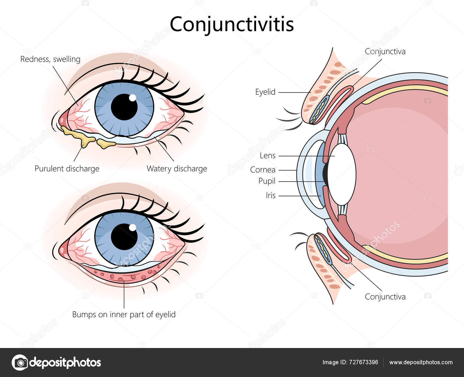 Conjunctivitis Symptoms Eye Anatomy Including Redness Swelling ...