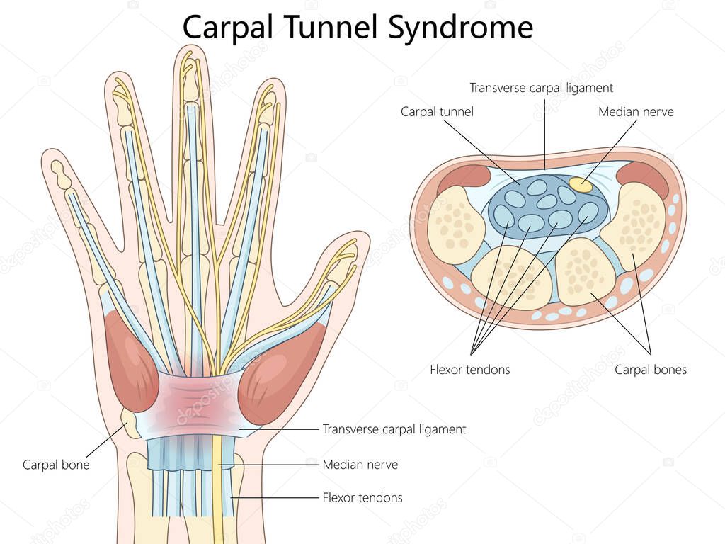 Anatomy of carpal tunnel syndrome, highlighting the median nerve ...